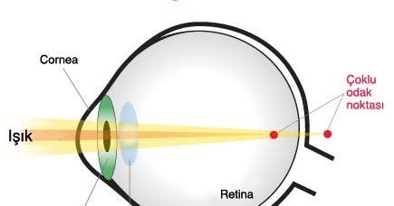 Astigmatizma Neden Olur Belirtileri Ve Nasıl Tedavisi Edilir