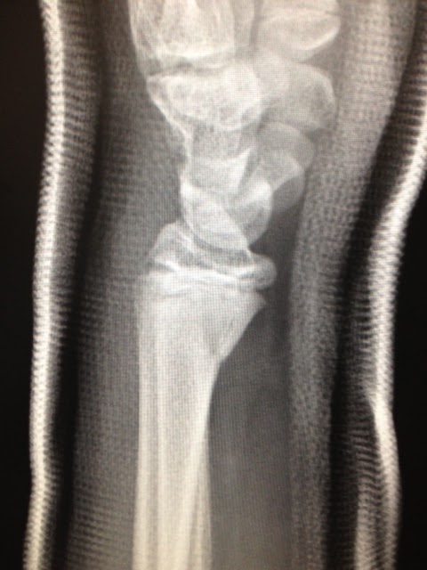 NP For Rent: Pain management in wrist fractures