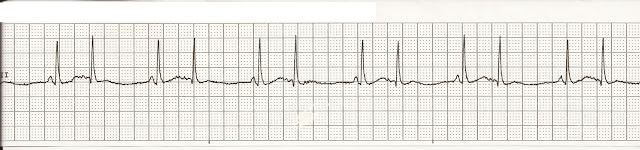 EKG Rhythm Strips 26: Ectopic beats