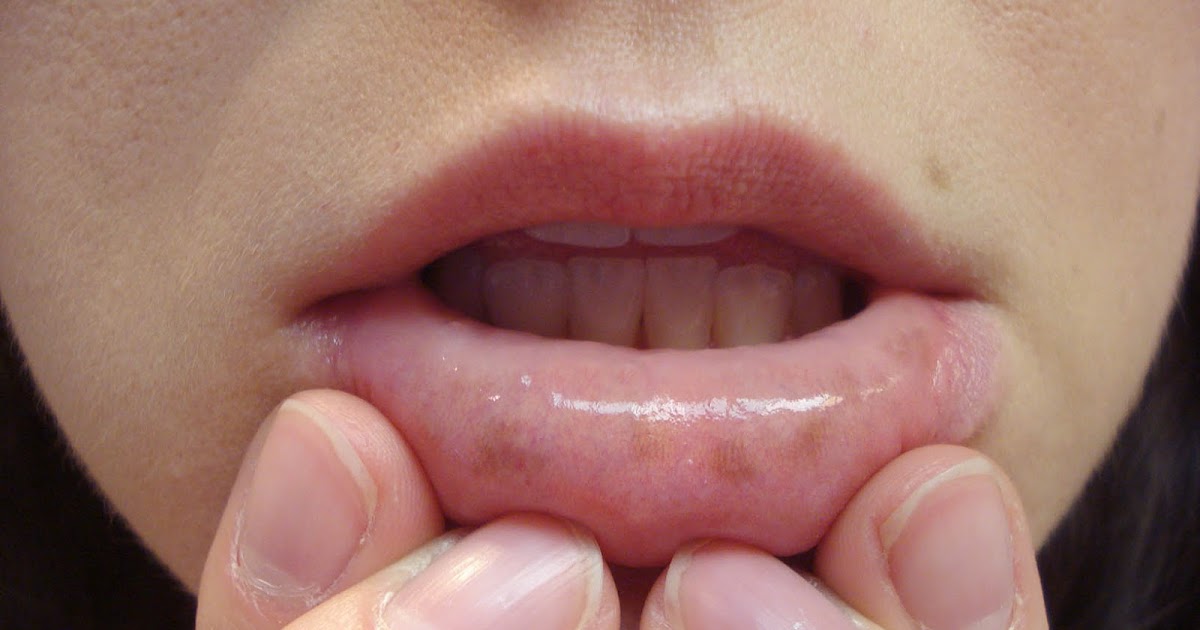 VIRTUAL GRAND ROUNDS IN DERMATOLOGY 2.0: Labial Macules