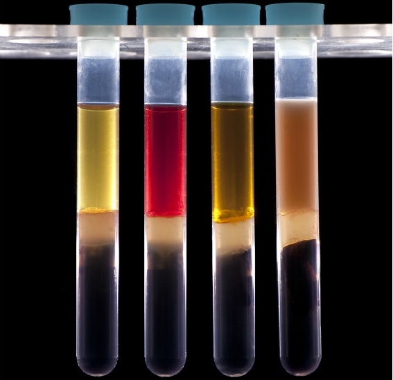 Alterações em Amostras de Soro Sanguíneo - Tira o Jaleco