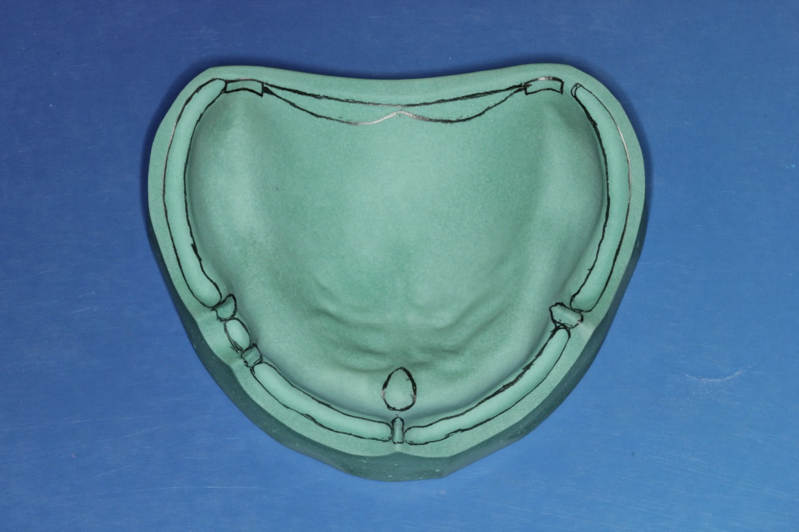 Understanding Prosthodontics - Tagore Dental College & Hospital-By ...