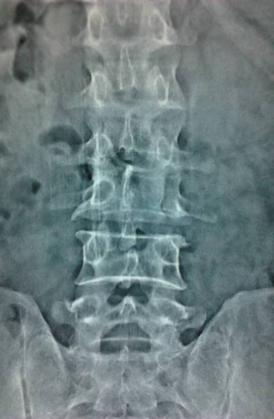 Winking Owl Sign-Plain Film - Sumer's Radiology Blog