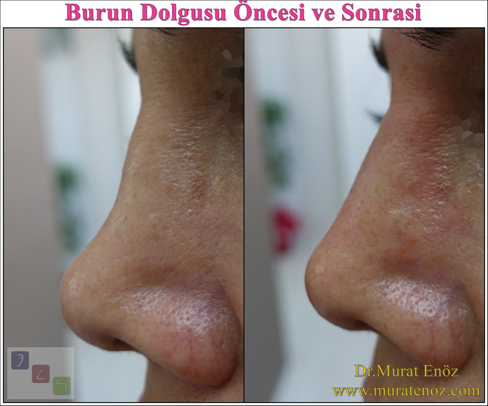Burun Dolgusu Öncesi ve Sonrası Fotoğrafları