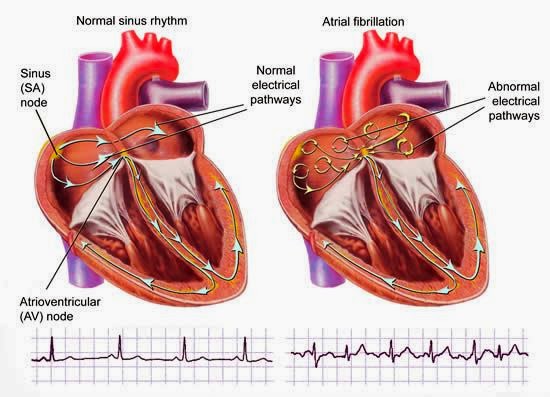 Fibrilhação Atrial ou Auricular – Definição, Causas, Sintomas ...
