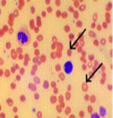 Anemia Hemolitik ~ Informasi Kedokteran Dan Kesehatan