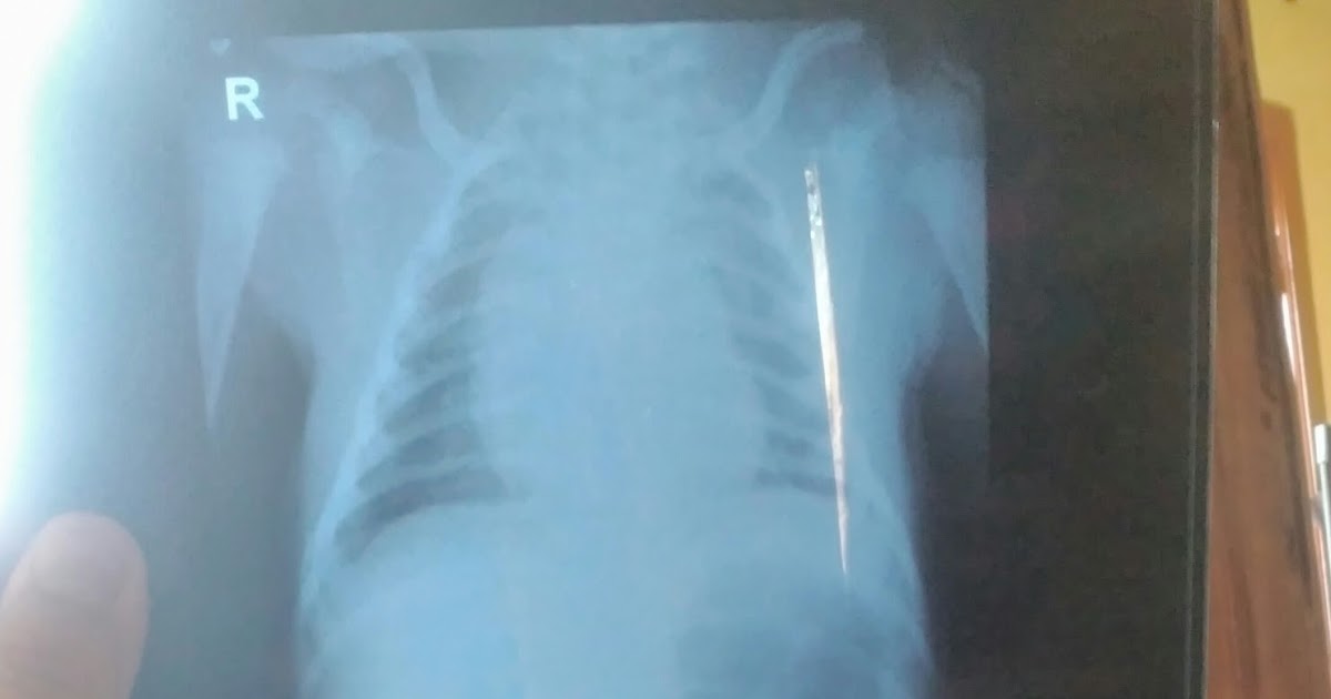 Mom2K's World: MESOCARDIA