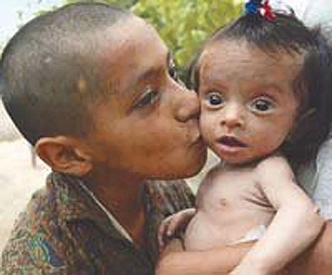 Los Niños de Honduras: La Desnutricion