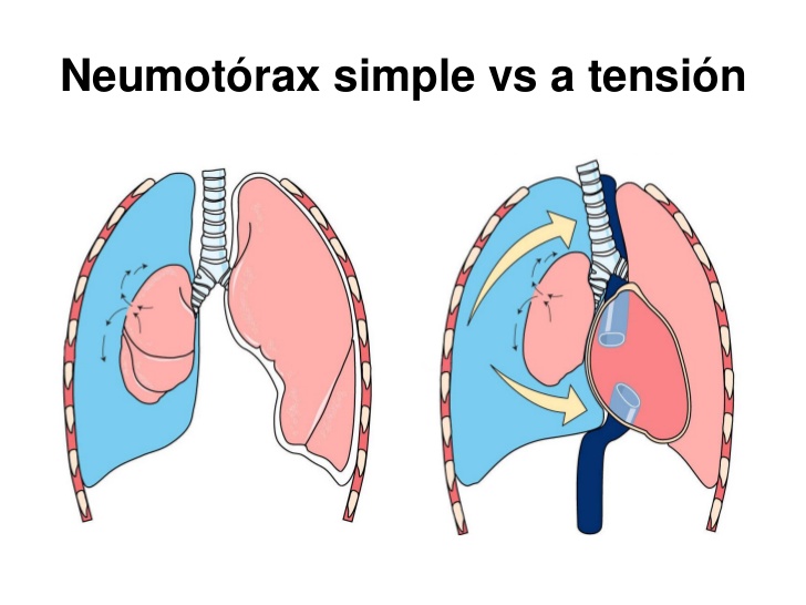 Todo sobre enfermería y medicina: Neumotórax simple