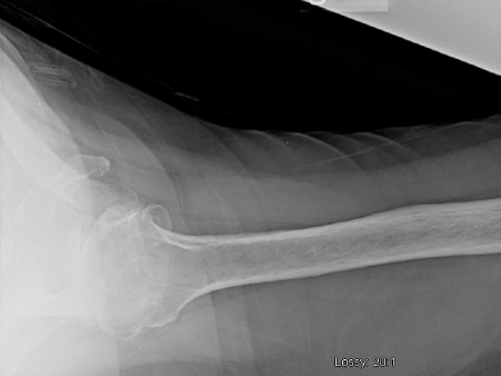 Shoulder and Elbow Surgery: Walch A2 glenoids and degenerative shoulder ...