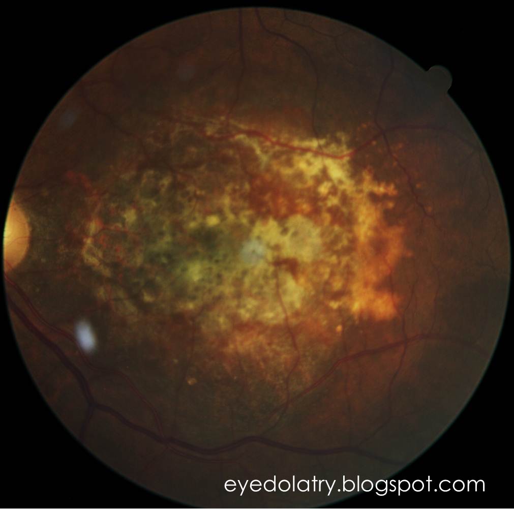 Retinal Photography: Macula - Eyedolatry