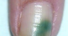 Pro Nail Tech Training: Common Nail Disorders: Chloronychia aka ...
