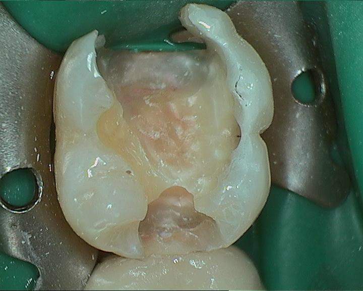sweet tooth: distal decay on 2nd molars.