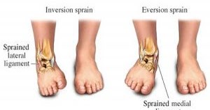 Most Common Volleyball Injury
