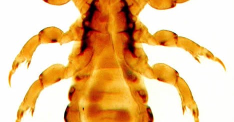 About Health: Lice infestation