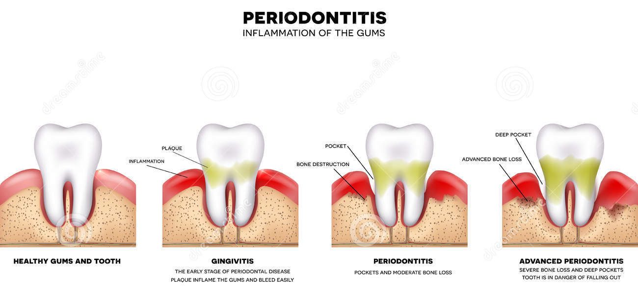 SATPEL RADANG GUSI (GINGIVITIS) - Seputar Kesehatan Gigi