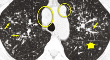 Chest Medicine Made Easy-Dr Deepu: BASICS OF HRCT INTERPRETATION-PART 3 ...