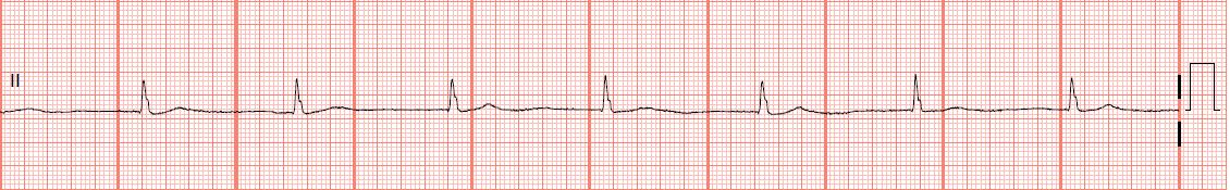 EKG Rhythm Strips 29: Junctional Rhythms