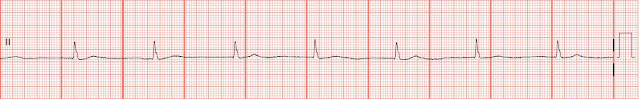 EKG Rhythm Strips 29: Junctional Rhythms