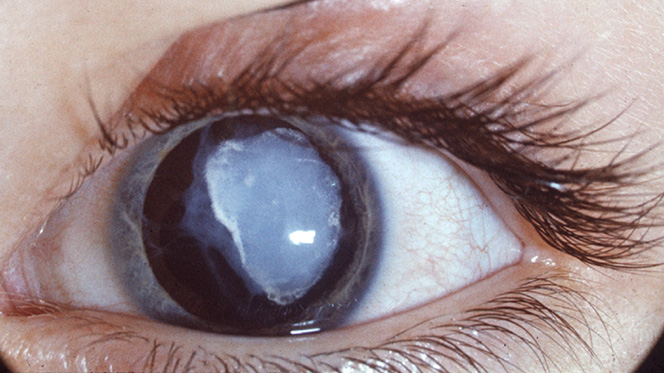 Deformutilation: Cataracts