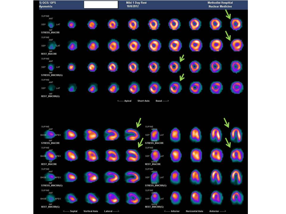 The Pump and the Tubes: Transient Ischemic Dilatation