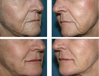 How To Use Facial Yoga To Get Rid Of Smile Lines And Mouth Wrinkles ...