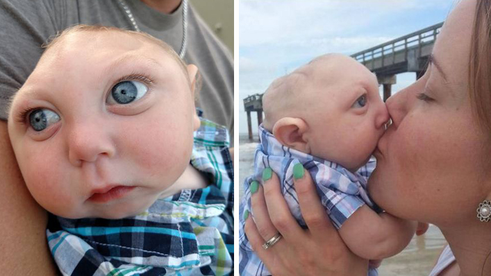 Photos: Jaxon Buell Strong, Baby Born With Half Skull Marks 2nd ...