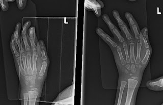 L1 Syndrome and the Thumb | Congenital Hand and Arm Differences ...