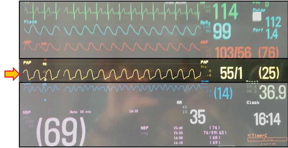 PediCardiology Quiz Answers: Quiz #9: Where is the tip of the PA line?