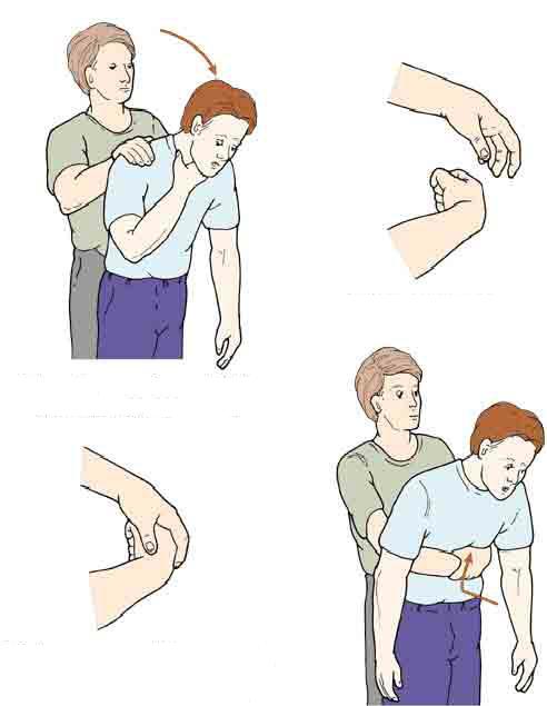 Primeros Auxilios IES San Blas Lucia FC: Asfixia