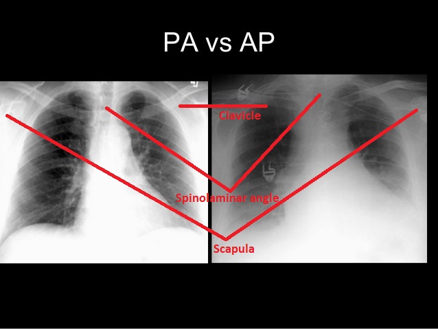 MBBS DOCTORS: Basics of Reading Chest X ray
