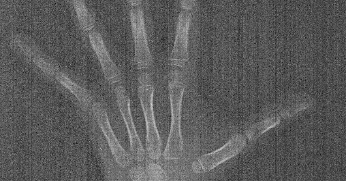 Gelastic Seizures Bone Age X Ray