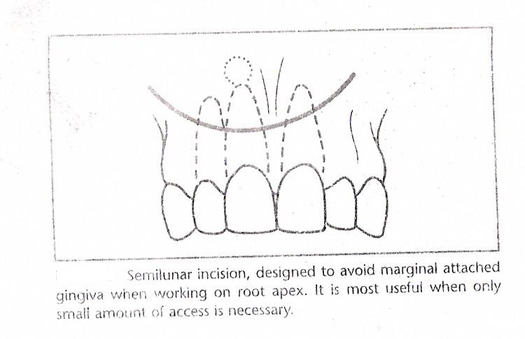 WizDent: Principles Of Complicated Exodontia-Surgical/Open method of ...