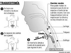 Tracheostomy Emergencies Obstruction, Decannulation,, 58% OFF