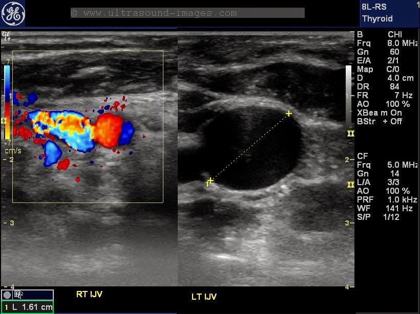 Phlebectasia of left Internal Jugular vein ~ Ultrasound Cases Info