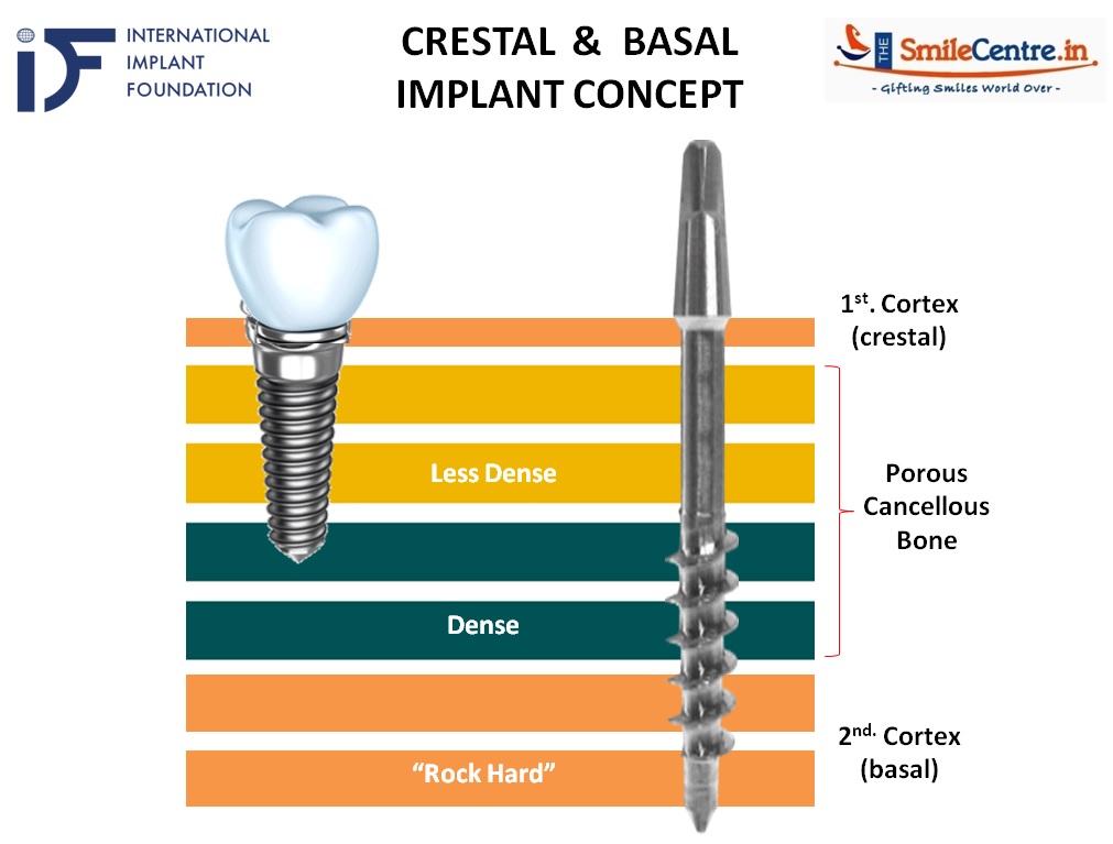 Strategic Implantology - A boon for the Patient as well as the Doctor ...