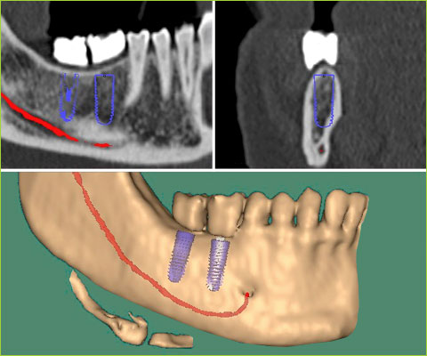 FRENKENKLINIK: Knochenaufbau