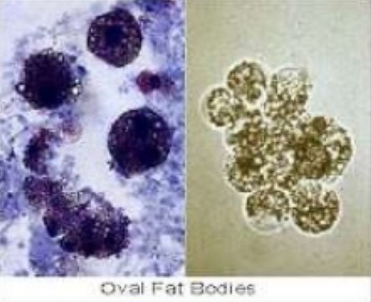 kimia klinik: Pemeriksaan sedimen urine