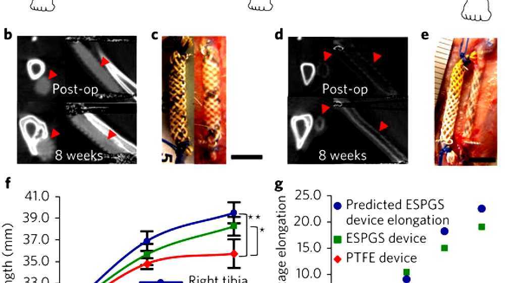 Poly Implant Prothèse