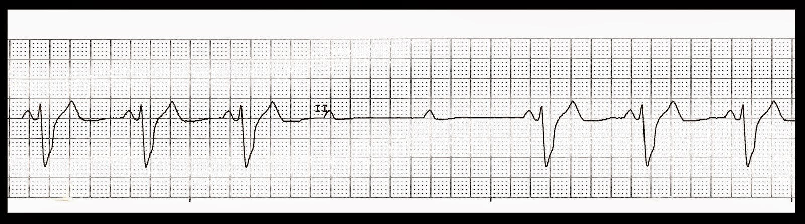 Float Nurse: Various 2nd Degree Heart Block Type II