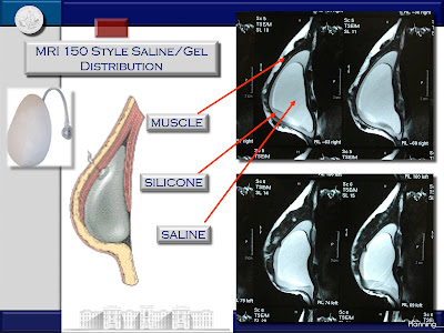 Reconstrução Mamária: Implante-Expansor Biodimensional 150-style