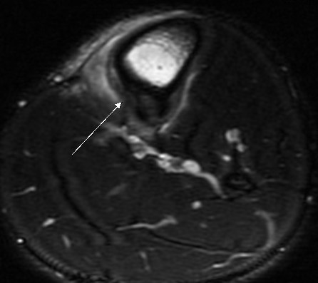 Tibial Stress Fracture-MRI - Sumer's Radiology Blog