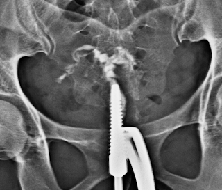 Asherman syndrome-HSG - Sumer's Radiology Blog