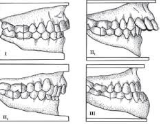 Clasificación de las maloclusiones