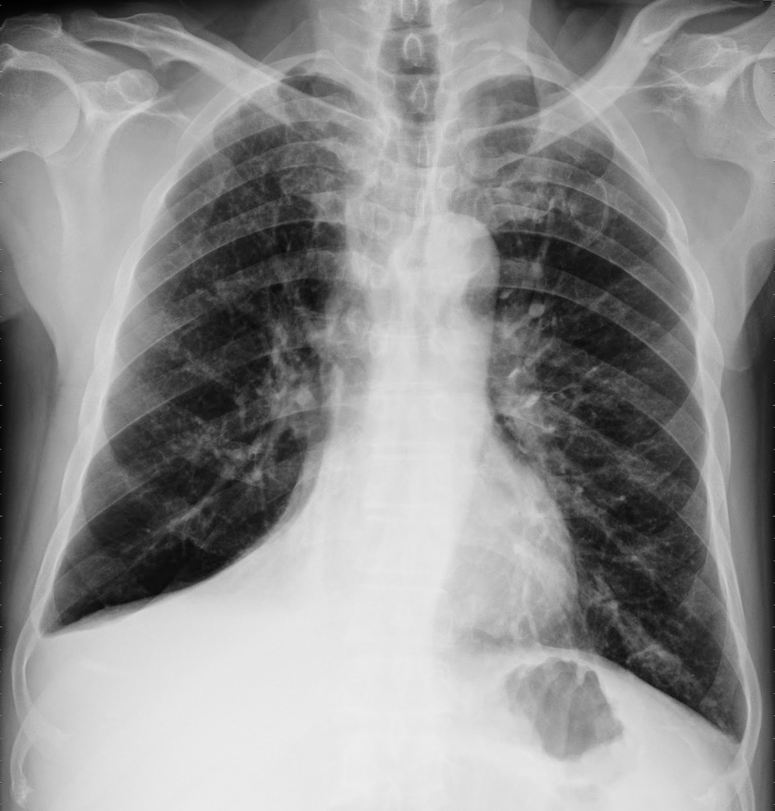 CXR 胸部x光判讀 right lower lobe (RLL) and right middle lobe (RML) collapse