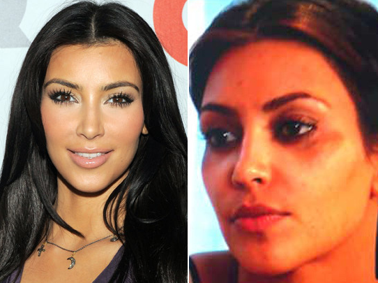 Qualitytime: Celebs Who Have Used Botox