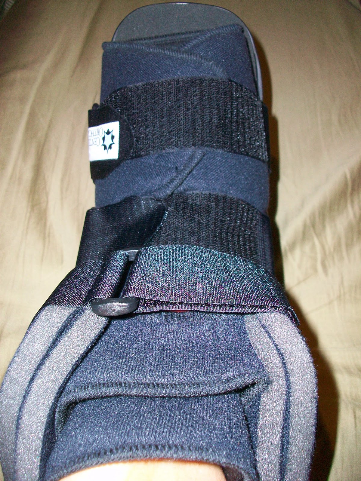 Angie Kay Dilmore: Recovering from Foot Surgery -- 4 days post-op