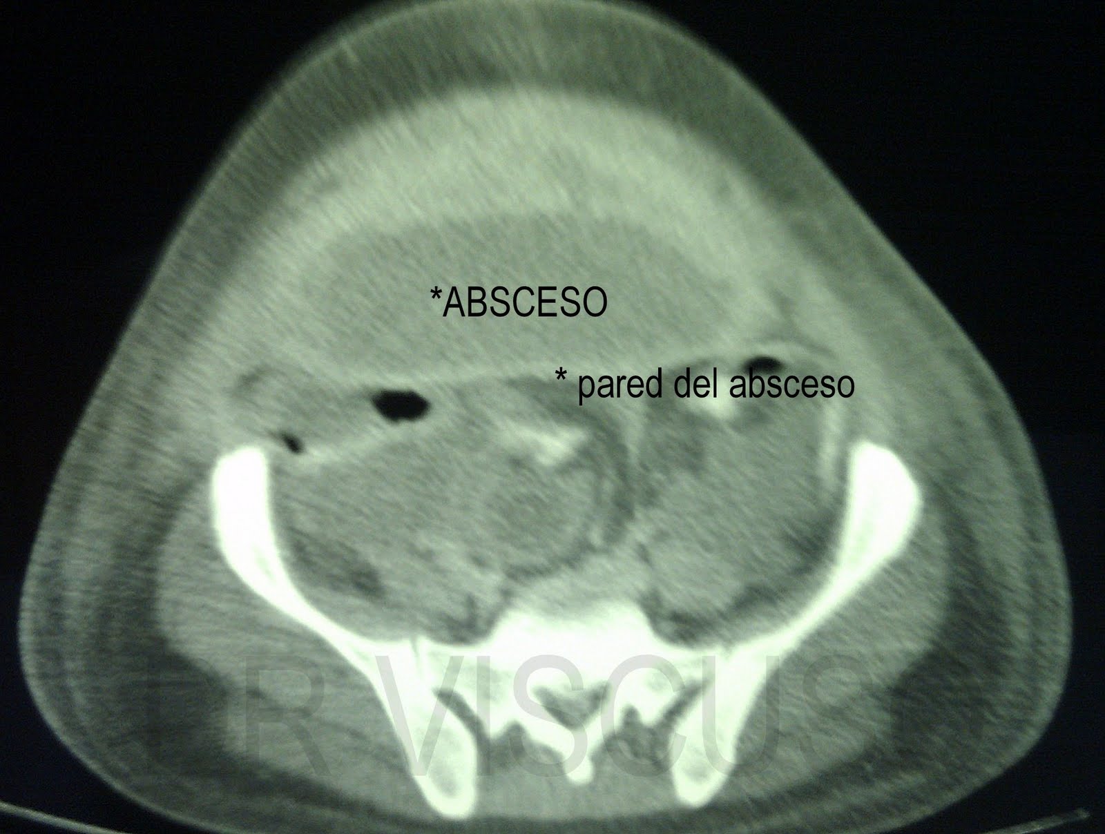 Que vi hoy: Absceso intraperitoneal