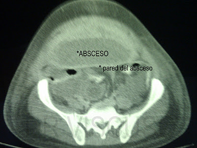 Que vi hoy: Absceso intraperitoneal