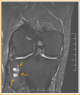 Lateral Knee Pain: Proximal Tibiofibular Joint Degenerative Arthritis ...